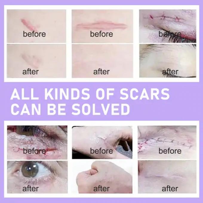 Scar Reducer Patches Advanced Skincare Hydrocolloid Scar Sheets Reduce ...