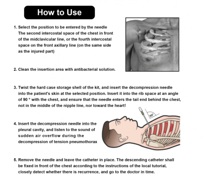 Pneumothorax Needle Chest Tension Cathether Needle trauma ...